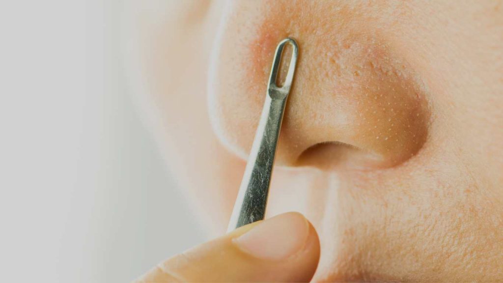 Why You Should Never Pop a Nose Pimple - Urban Woman Magazine